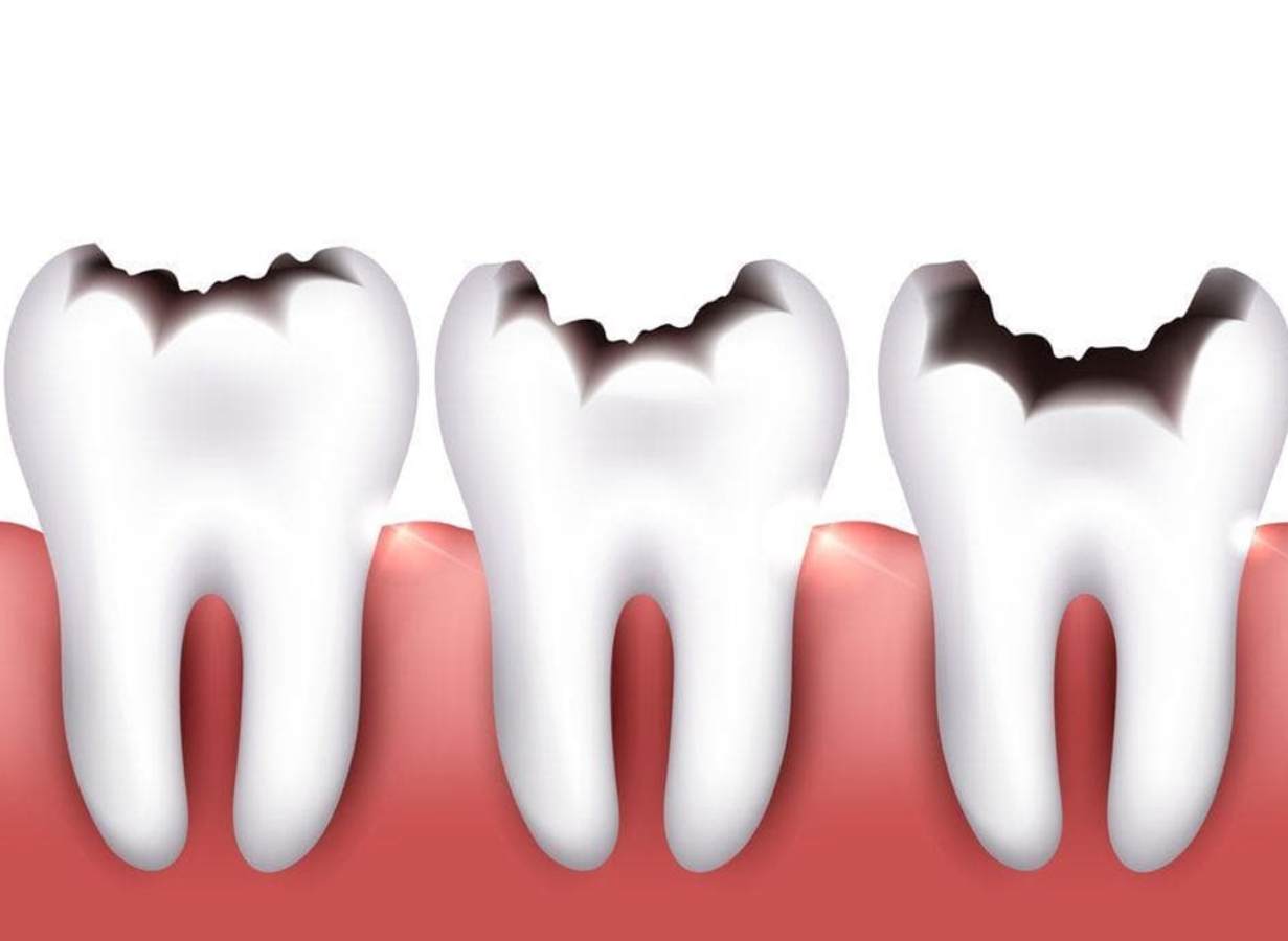 ¿Por qué se produce la caries dental? – Dentas Tool